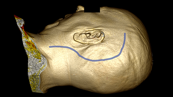 Petrosal approaches - 3D Atlas of Neurological Surgery